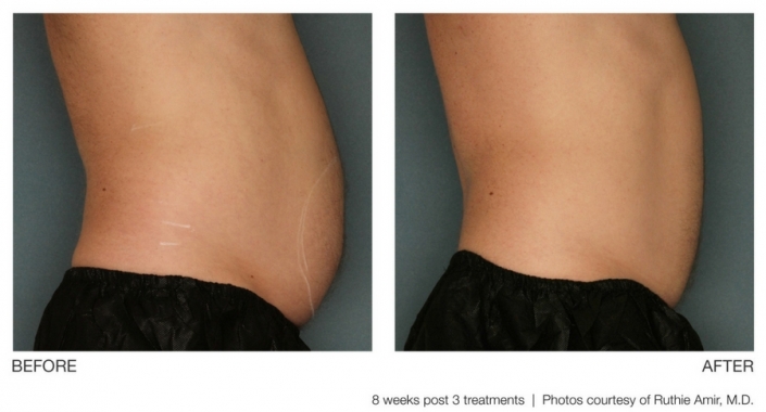 UltraShape Permanent Fat Reduction Naperville Plainfield Illinois