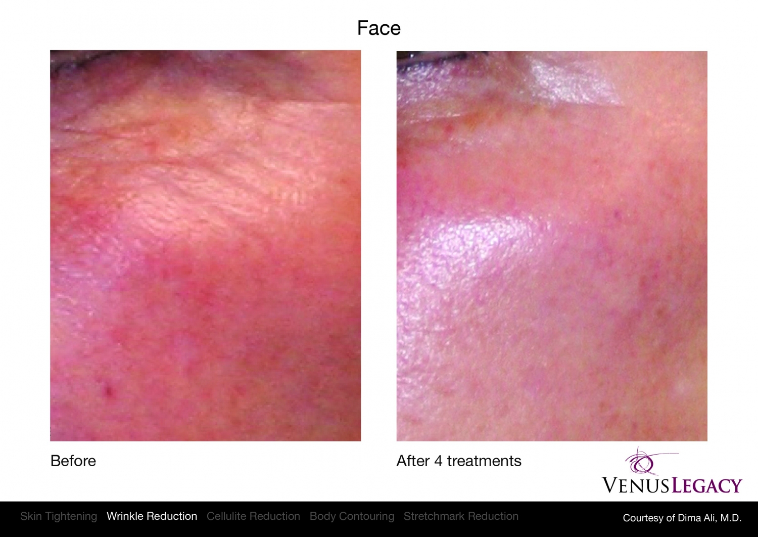 Naperville Venus Freeze | Venus Freeze Facial Treatment Naperville ...