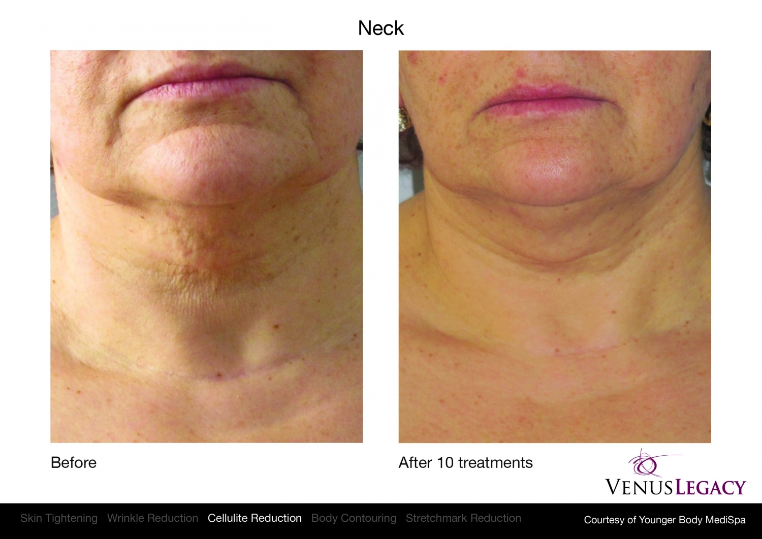 Naperville Venus Freeze | Venus Freeze Facial Treatment Naperville ...