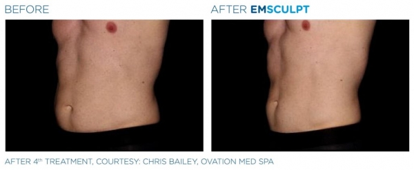 Emsculpt Near Me Build Muscle And Burn Fat Permanently With