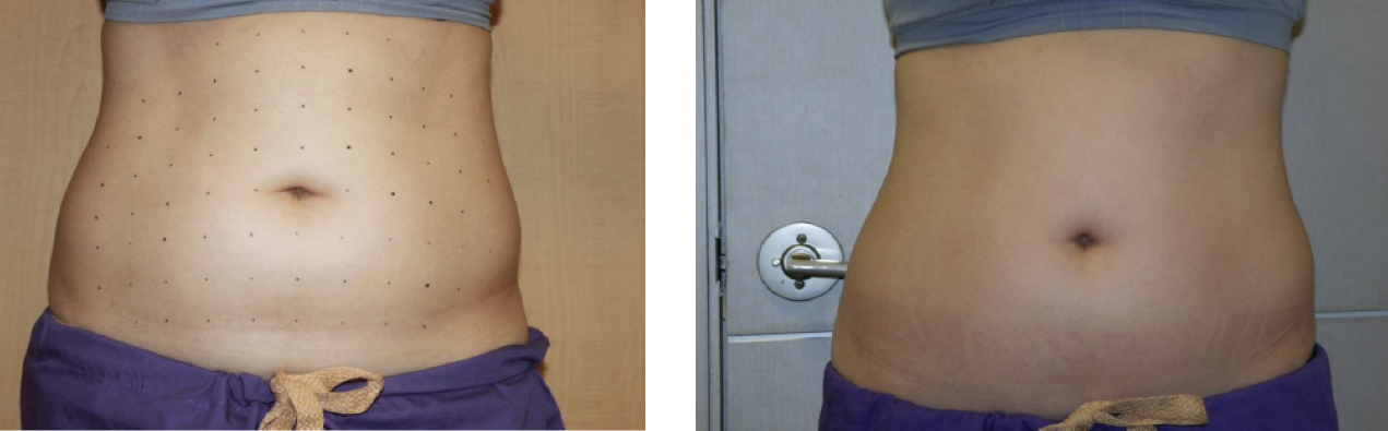 LIPOcel Near Me | LIPOcel Permanent Fat Loss & Skin Tightening in ...