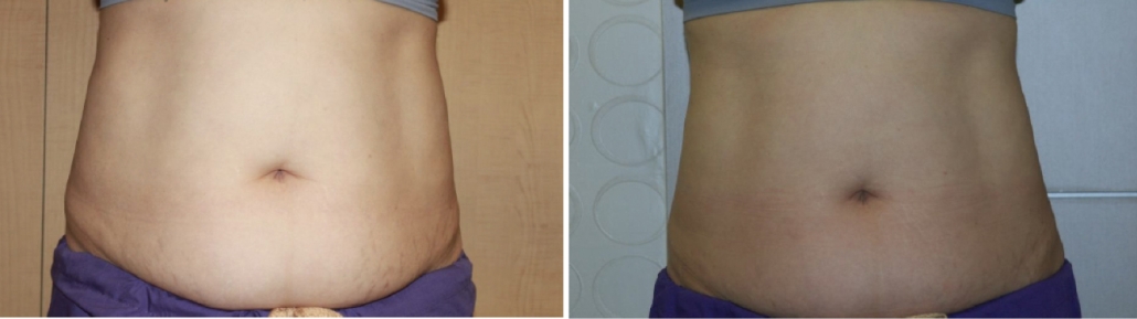 LIPOcel Near Me | LIPOcel Permanent Fat Loss & Skin Tightening in ...