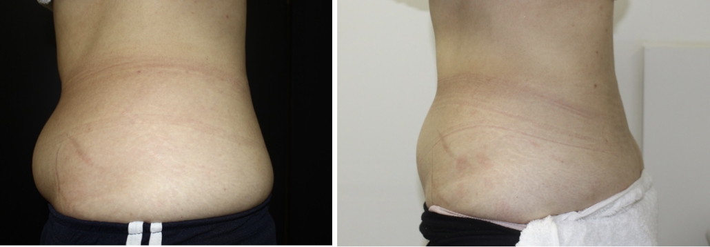 LIPOcel Near Me | LIPOcel Permanent Fat Loss & Skin Tightening in ...