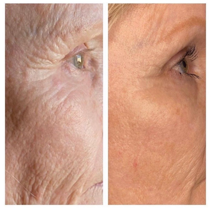 Cool Jet Plasma Naperville | Cool Jet Plasma Facial Near Me ...