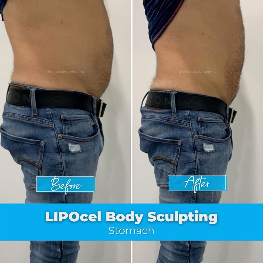 LIPOcel Near Me | LIPOcel Permanent Fat Loss & Skin Tightening in ...