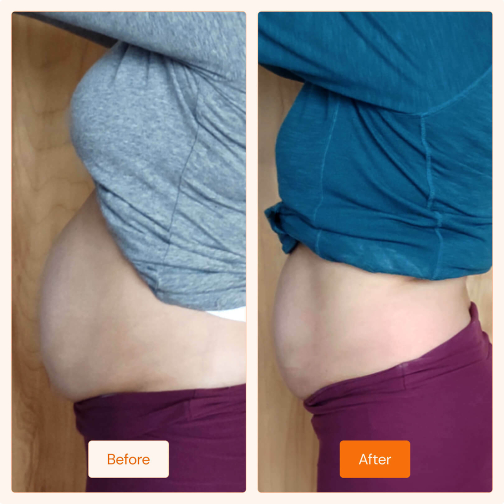 CRYOSculpting Near Me | Cryolipolysis Permanent Fat Loss & Skin ...