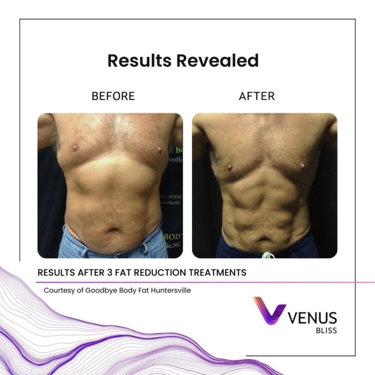 Venus Bliss Max in Naperville | Body Contouring Near Me